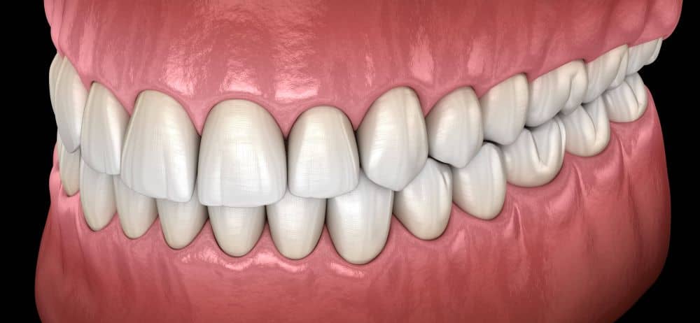 Cómo es una mordida perfecta - midentista Valencia